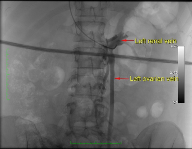 Ovarian Vein Embolisation Specialist Endovascular Services